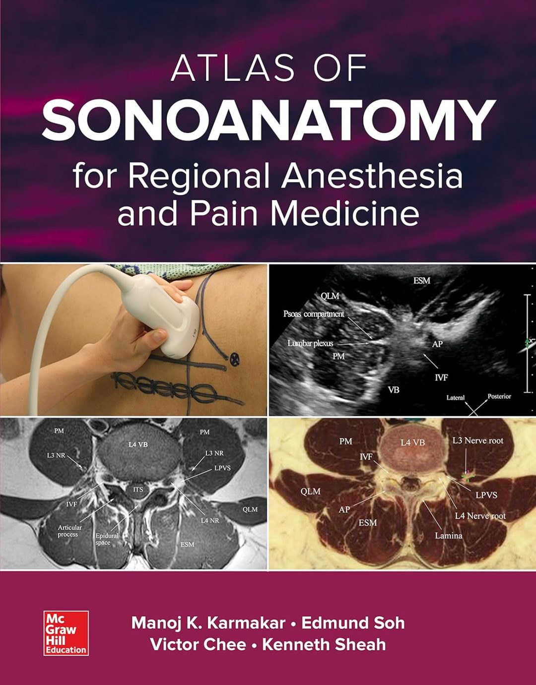 Atlas of Sonoanatomy for Regional Anesthesia and Pain Medicine | PDF ...