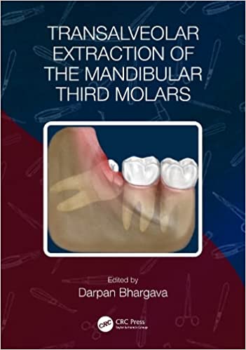 Transalveolar Extraction of the Mandibular Third Molars First Edition ...
